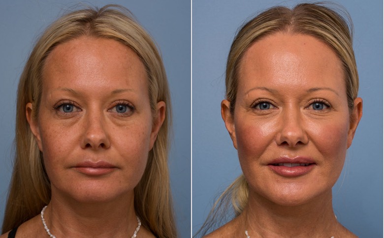 Dermal Filler Injections – Moon Tree Aesthetics
