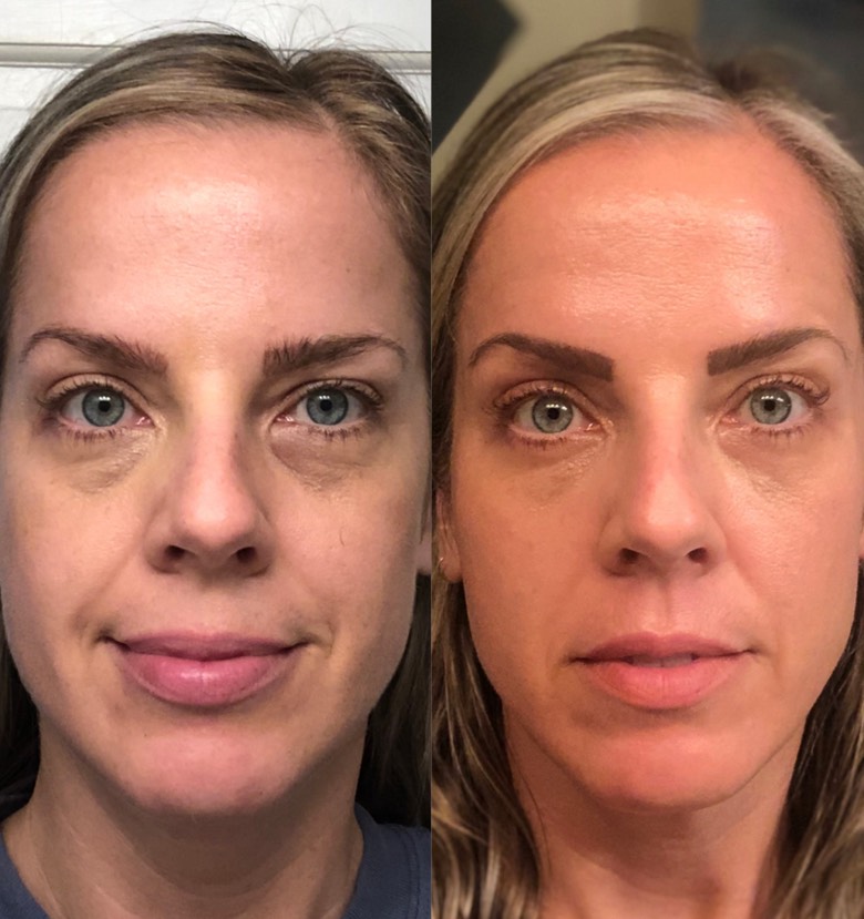 Vampire Facial® – Moon Tree Aesthetics